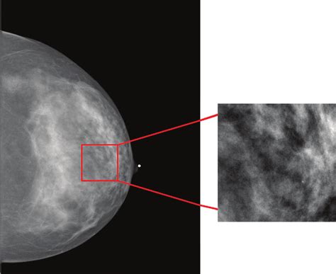 Normal Digital Mammogram How To Read Mammogram Results Bi Rads