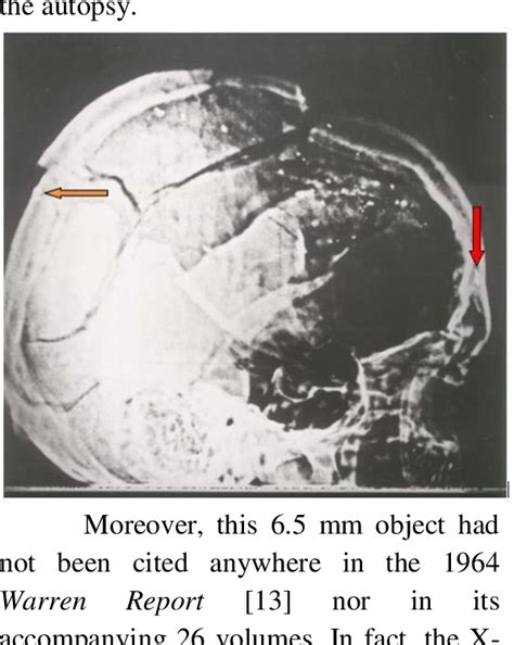 Figure 1 From The John F Kennedy Autopsy X Rays The Saga Of The