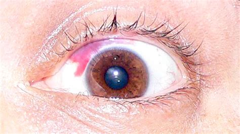 Hemorrhage In Eye