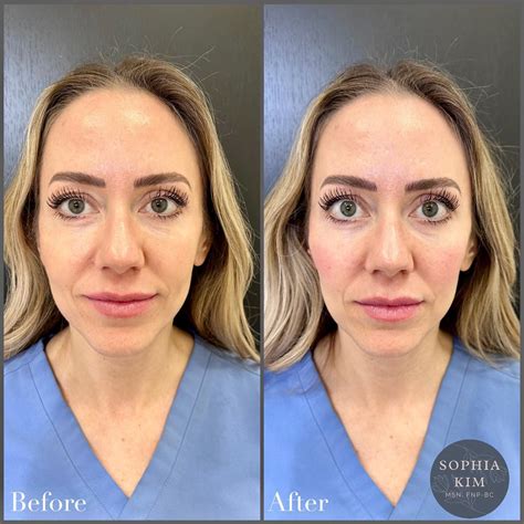 1 Ml Cheek Filler Before And After