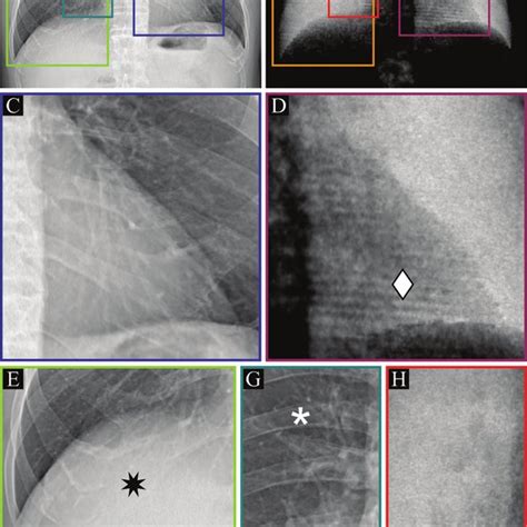 Attenuation Based Left And Dark Field Right Posteroanterior