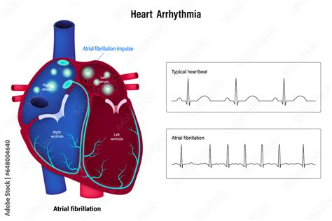 Heart Arrhythmia Vector Cardiac Arrhythmia Atrial Fibrillation An Irregular Heartbeat Stock