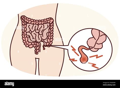 Closeup Of Human Body With Inflamed Appendix Person Suffer From Appendicitis Need Surgery