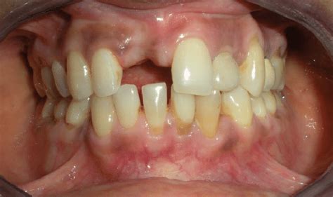 Intra Oral View Showing Buccal Defect In 11 Region Download Scientific Diagram