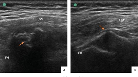 Table 1 From Clinical Utility Of Musculoskeletal Ultrasound In
