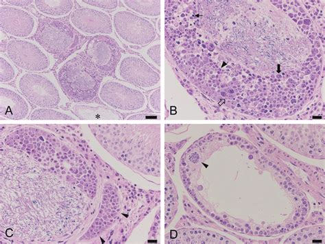 Histological Findings Of The Intratubular Seminoma And Tubular Atrophy