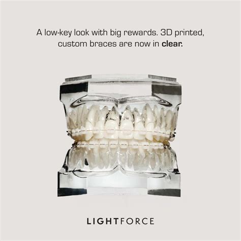 Calgarys Brightest Smiles Lightforce Clear Braces At Marda Loop Braces