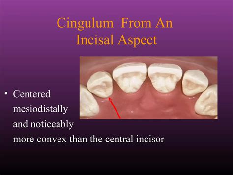 Maxillary Lateral And Mandibular Incisors Ppt