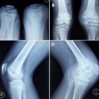 Plain X Ray Of The Left And Right Knee A Sunrise View B Weight
