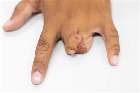Abnormal Fingers Caused By Genetic Diseases For Education In