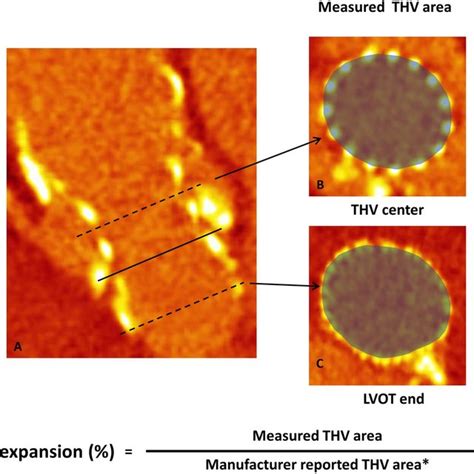 Determination Of Prosthesis Expansion Pre Tavi Cta Sagittal Oblique