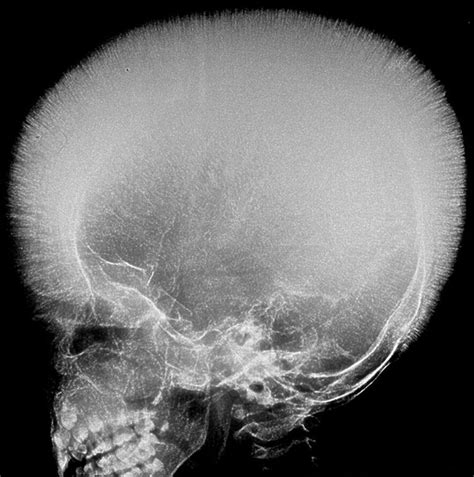 Hair On End Appearance Of The Skull Is Usually Seen In Patients With