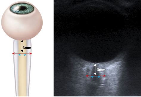 W Alberto Sifuentes Giraldo On Linkedin Optic Nerve Arteritis Perineuritis Arteritic