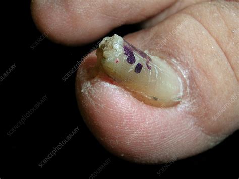 Pincer Nail Deformity Stock Image C0564975 Science Photo Library