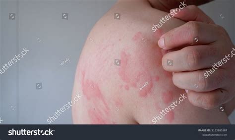 What Are Hives And Symptoms Of Hives Allergy Immunology 58 Off