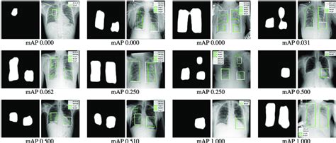 Qualitative Performance On The Kaggle Rsna Pneumonia Detection