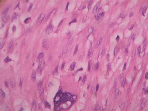 Gliosarcoma Atlas Histopathologyguru