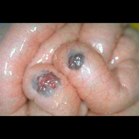 Teenager With Black Blue Subcutaneous Nodules And Chronic Gi Bleeding Pediatric Radiology Case