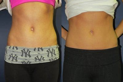 Belly Button Surgery Before And After Pictures Realself
