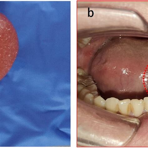 The Self Condensing Plastic Plug A Within The Bone Cavity 4 5 Days Download Scientific