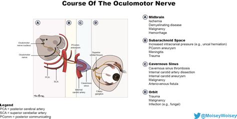 Oculomotor Nerve Palsy Aneurysm