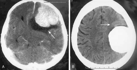Ct Evaluation Of Meningiomas Neupsy Key