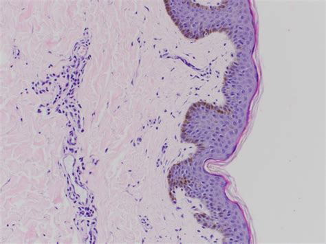 Idiopathic Atrophoderma Of Pasini And Pierini Case Report And Literature Review Pmc