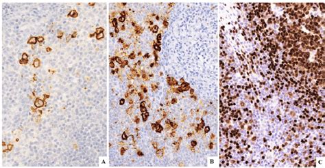 A Cd30 B Cd15 C Pax5 Weak Download Scientific Diagram