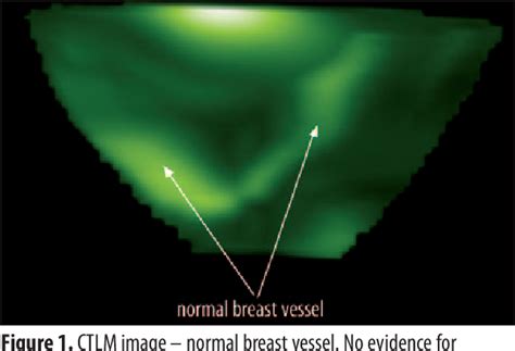 Computed Tomography Laser Mammography Semantic Scholar
