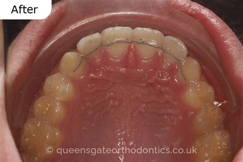 Invisalign South Kensington Queens Gate Orthodontics