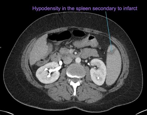 Ct Case 056 • Litfl • Ct Scan Interpretation