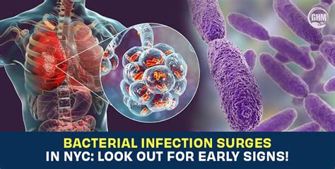 Bacterial Infection Surges In Nyc Look Out For Early Signs