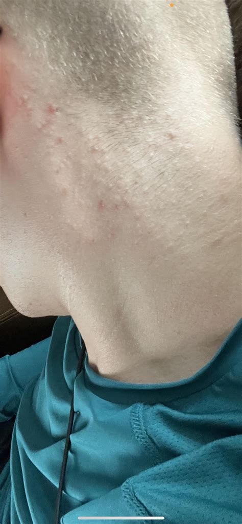 Why Is There A Line On The Back Of My Neck At Roger Monday Blog