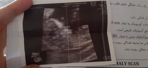 تشخیص جنسیت از روی سونو ان تیعکس میشه بیاید لطفا؟ تبادل نظر نی نی سایت