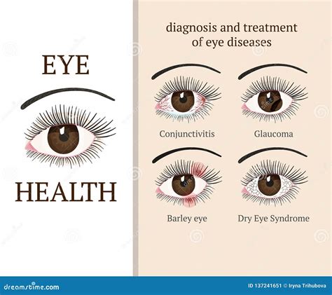 Conjunctivitis Types Inflammatory Diseases Of Eyes Cartoon Vector