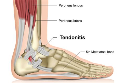 The 8 Best Treatments For Tendonitis In The Foot Cincinnati Foot And Ankle Care