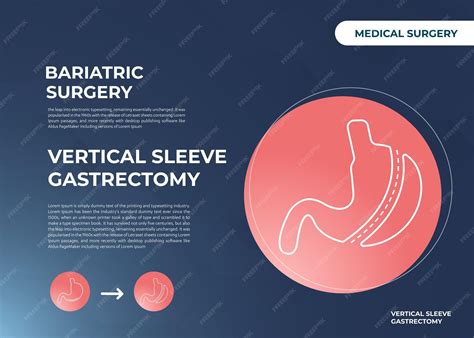 Premium Vector Laparoscopic Sleeve Gastrectomy Vertical Gastrectomy Weight Loss Surgery
