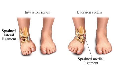 Anatomy Eversion Ankle Sprain