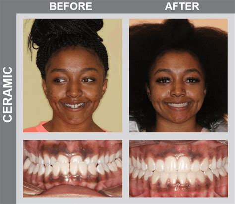Smile Gallery Before And Afters Ncoso Orthodontics