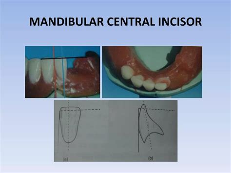 Arrangement Of Artificial Teeth Pptx