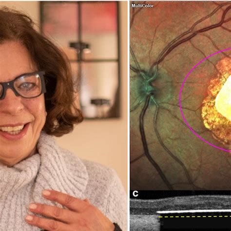 Prima System In Practice A Prima 2 Glasses On A Person B Fundus Photo Download Scientific