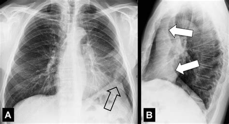 Fleischner Society Glossary Of Terms For Thoracic Imaging Radiology