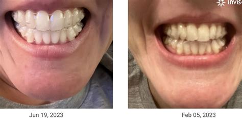 Sharing My Progress 2138 Rinvisalign