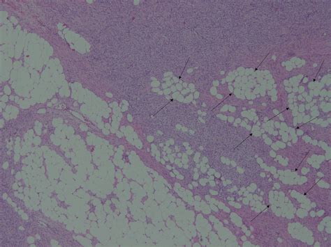 A 43 Year Old Woman With Dermatofibrosarcom Protuberans Presenting