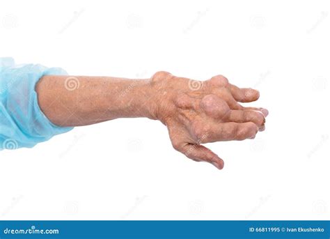 Man With A Diagnosis Of Polyarthritis Stock Image Image Of Form