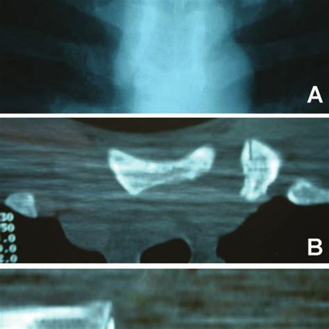 A Radiograph Demonstrating Posterior Superior Dislocation Of The Right Download Scientific