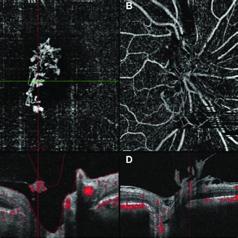 Oct Angiograms Of Pdr Treated With Laser Photocoagulation Left Column Download Scientific
