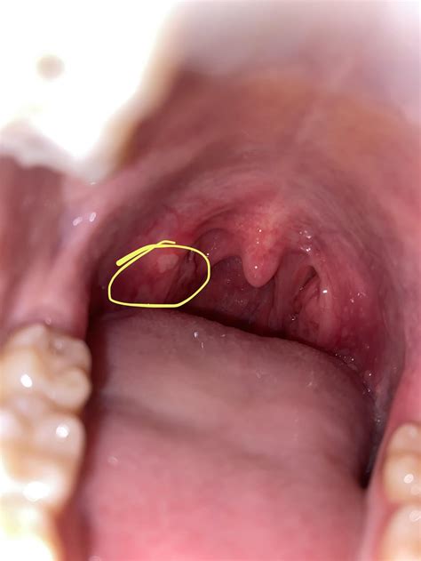 I Think I Have A Small Wound On My Tonsil From Where I Poked Around Too