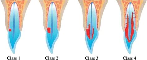 Challenges In Differential Diagnostic And Treatment Of Cervical Root