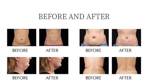 10 In 1 Latest Laser Lipo Cavitation Machine Skinsoft